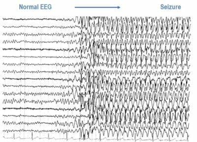 Photosensitive Epilepsy - Epilepsy Action Australia